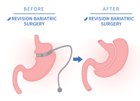 Revision Bariatric Surgery | Go Light Bariatrics