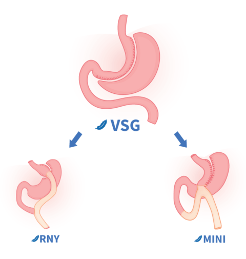 Revision Bariatric Surgery | Go Light Bariatrics